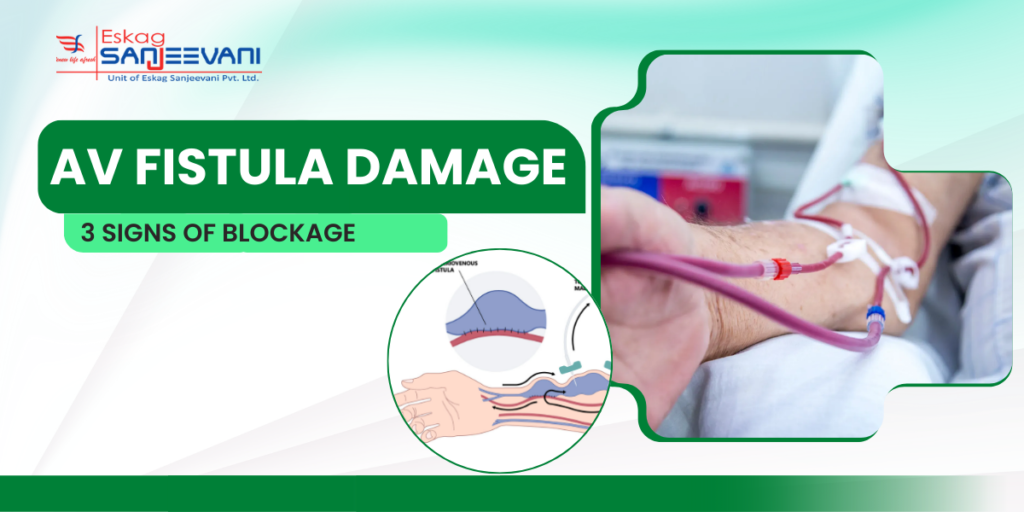 AV Fistula Blockage Signs | 3 Critical Warning Signs | Eskag Sanjeevani ...